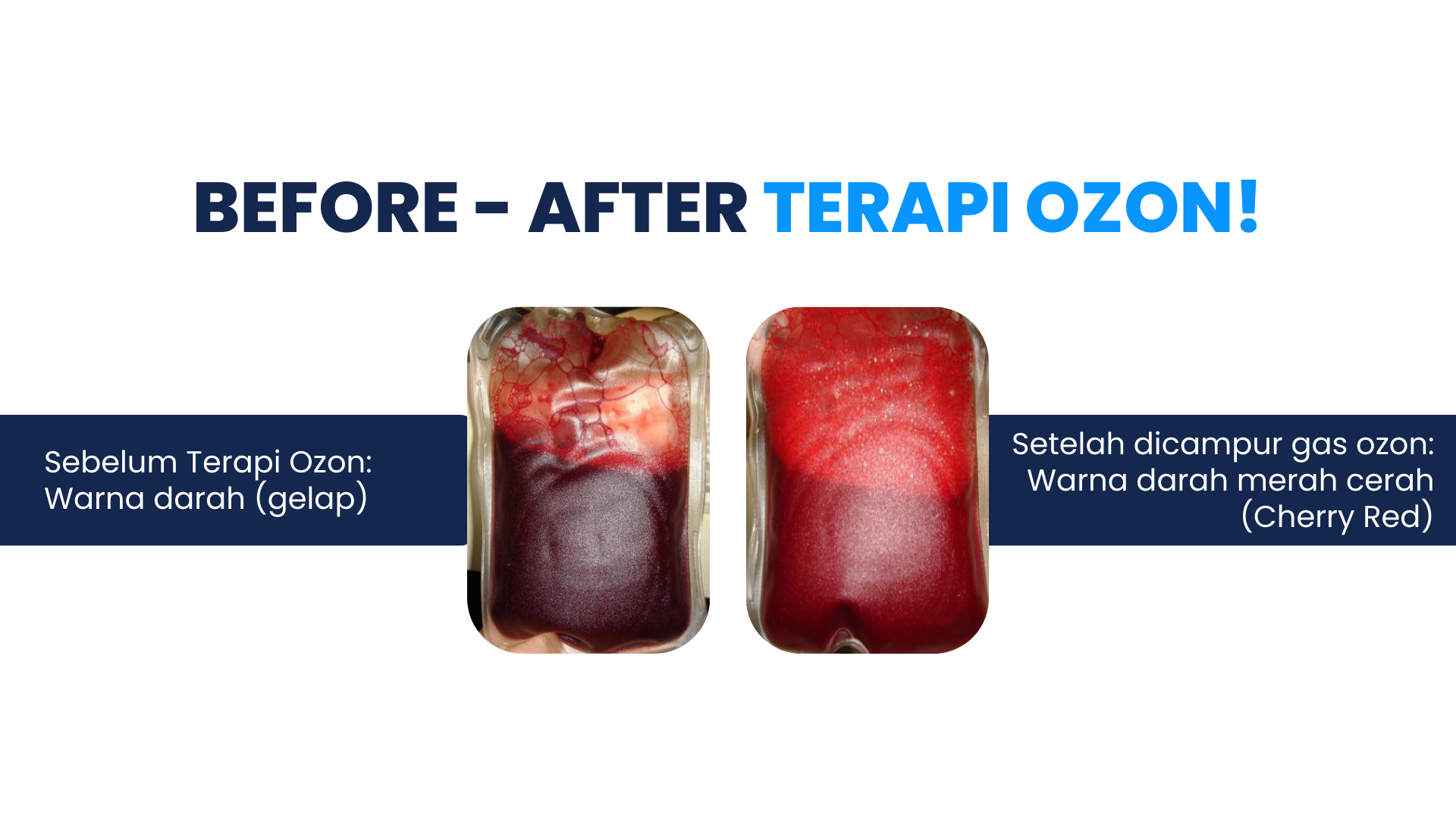 TERAPI OZON NEW – Holicare